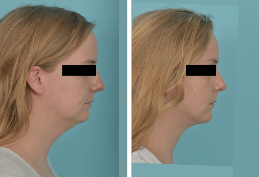 04 Neck Lipo Case 1 - Mobley MD