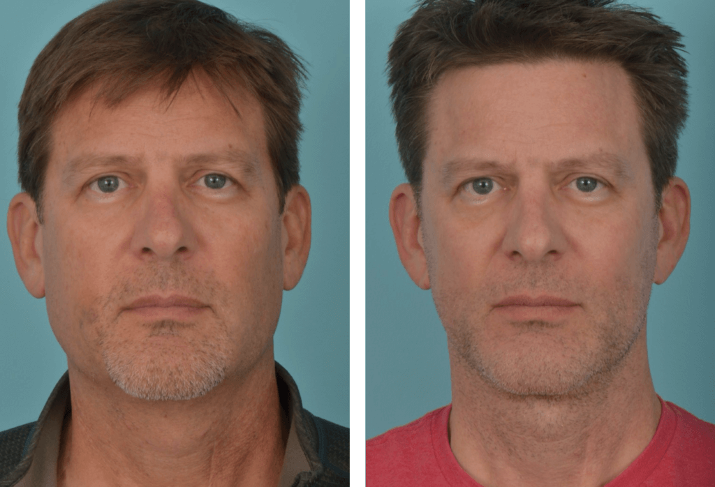 03 Facelift Case 4 - Mobley MD