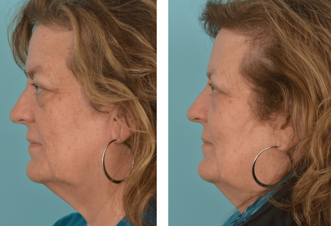 07 Bleph Lower Case 4 - Mobley MD