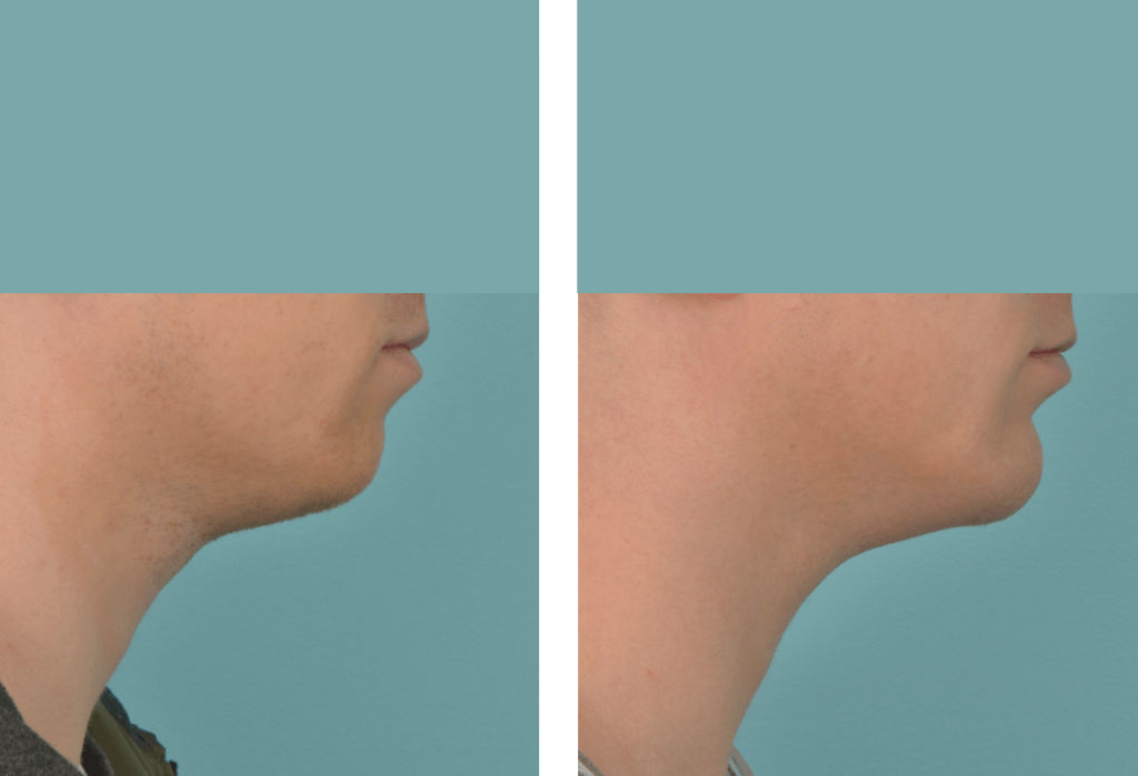Chin Augmentation | Utah | Mobley MD Facial Plastic Surgeon