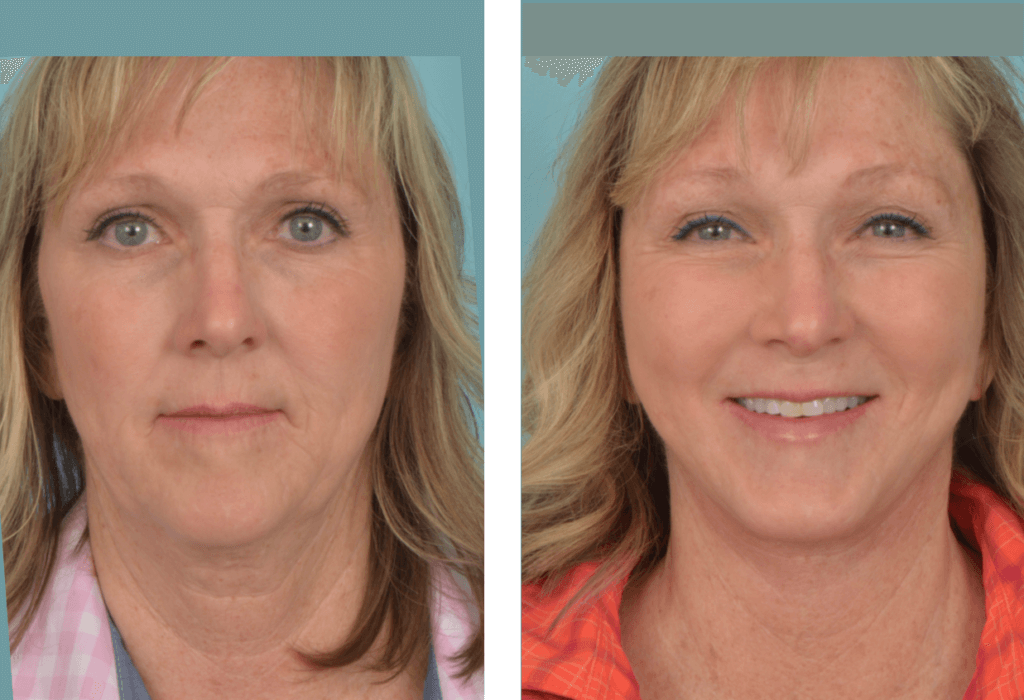 02. Neck Lift Case 19 - Mobley MD