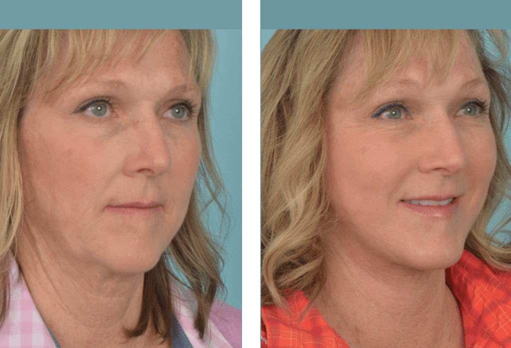 02. Neck Lift Case 19 - Mobley MD