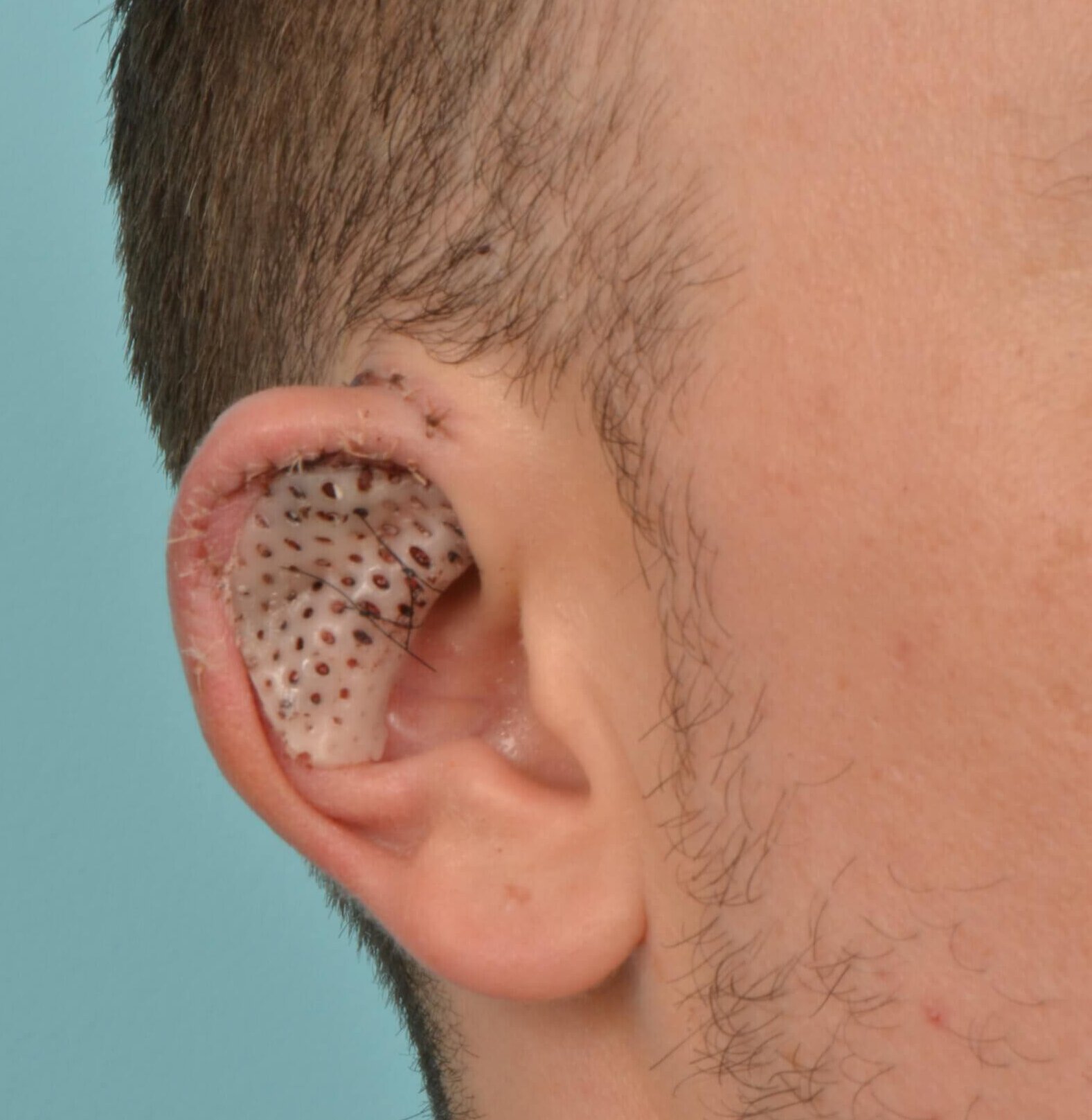 Otoplasty for Lop Ears - Mobley MD