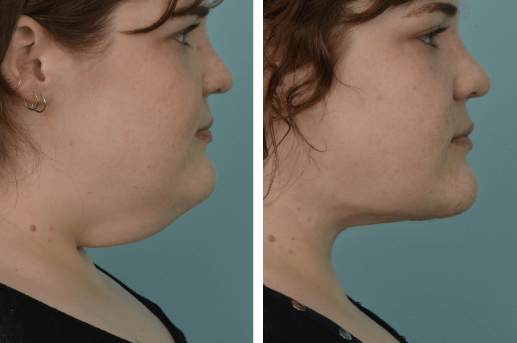 04 Neck Lipo Case 15 - Mobley MD