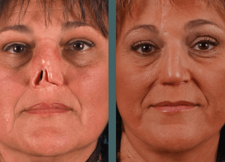 Forehead Flaps Surgery | Utah | Mobley MD Facial Plastic Surgeon